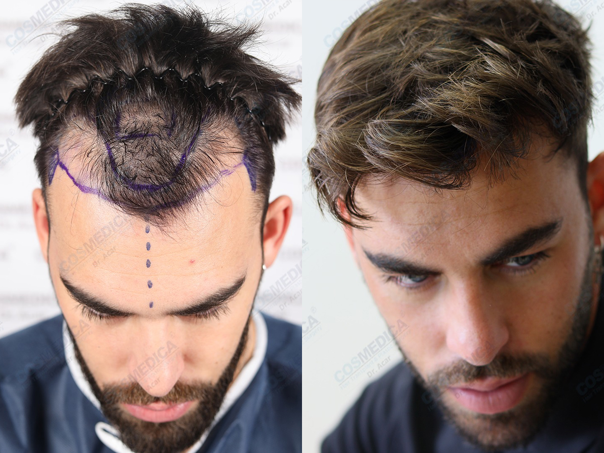 Hair Transplants In Turkey Low Cost High Quality Abc Money